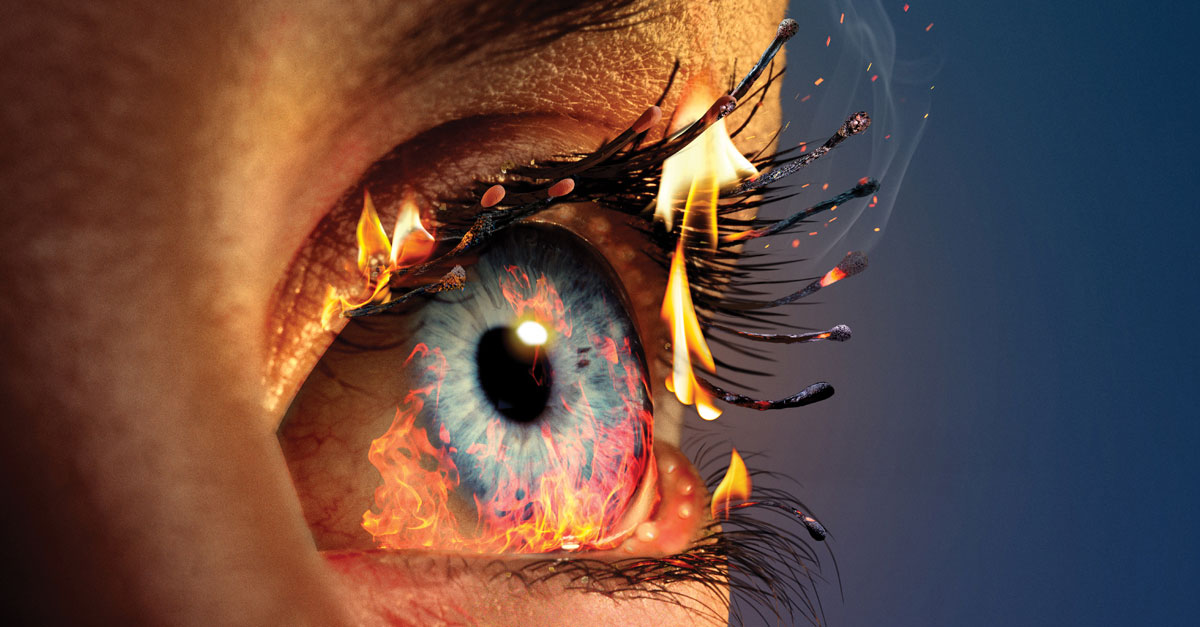 TOBRADEX® ST — For Ocular Inflammation With Risk of Infection